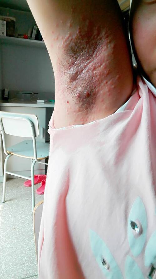 腋下毛囊炎图片图标