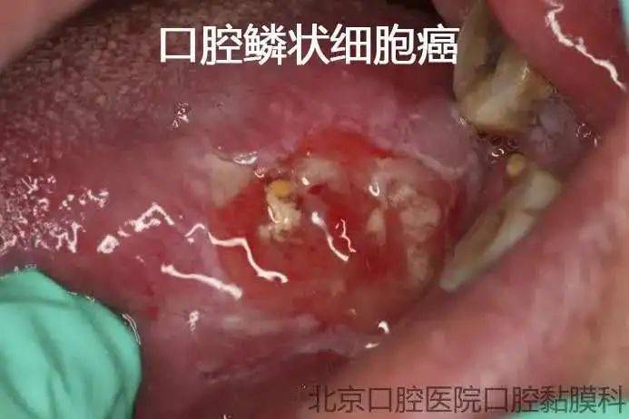 口腔溃疡病理检查怎么做图标
