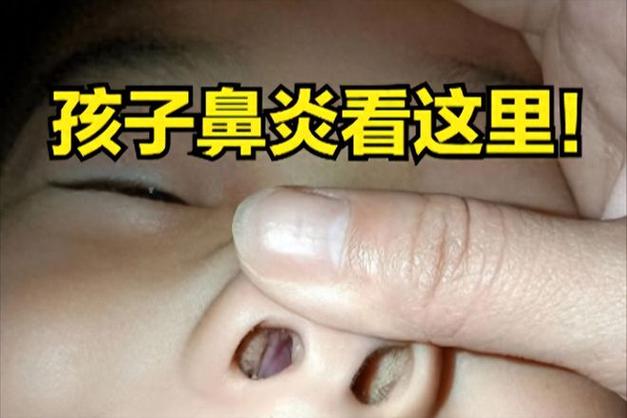 鼻窦炎一般能活几年图标