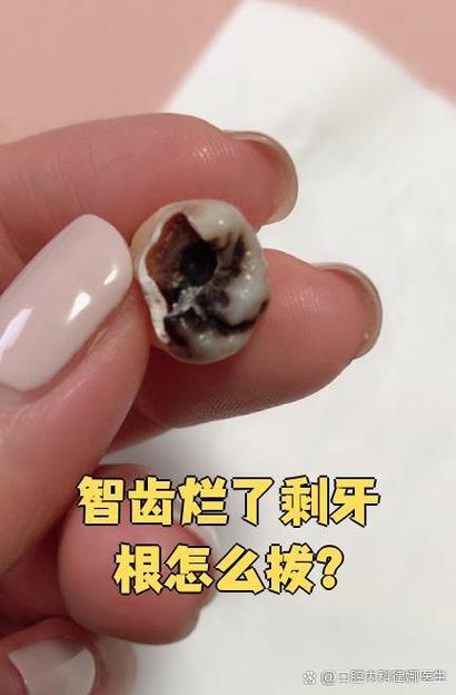 智齿蛀牙是拔好还是补截图