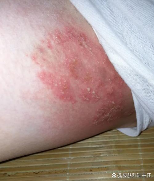 大腿内侧和胳肢窝痒痒越抓越痒图标