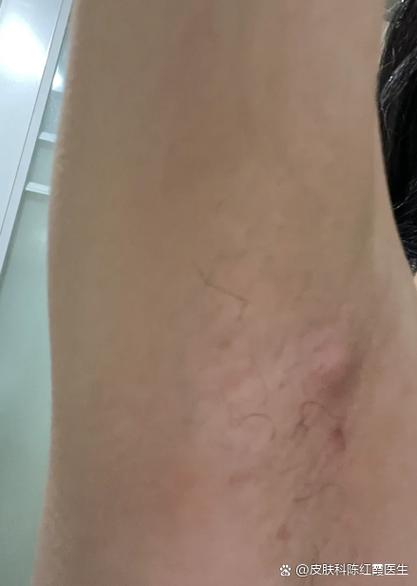 液窝痒是怎么回事图标
