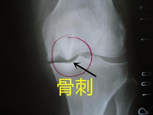骨刺一般能活几年图标