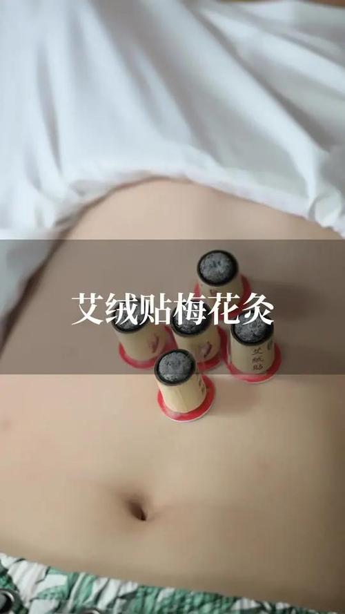 中脘梅花灸部位