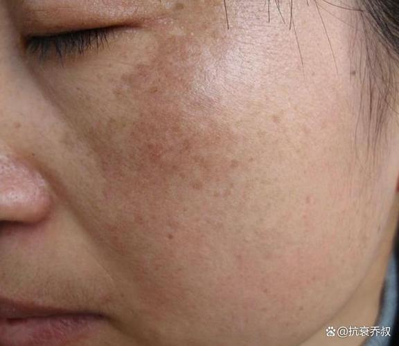 脸上长了一块黑斑