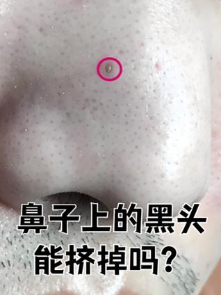 去掉脸上黑点的小妙招图标