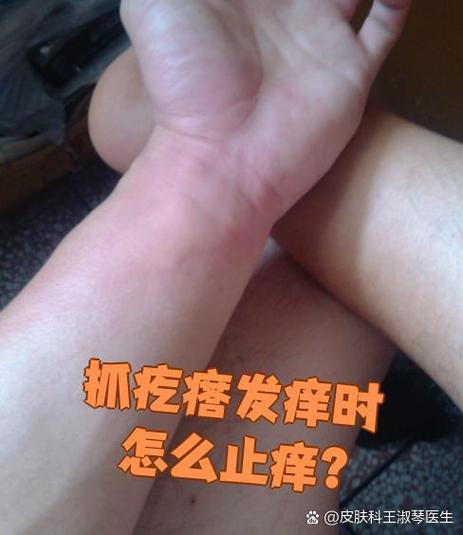 身上忽然起红疙瘩还特别痒图标