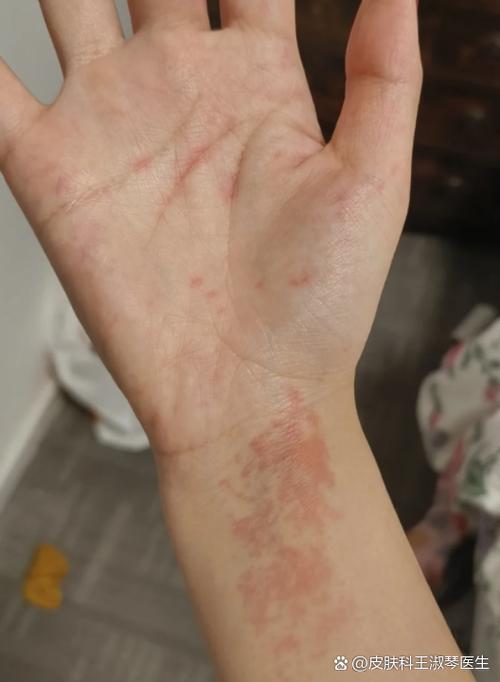 脸过敏可以吃鸡蛋吗图标