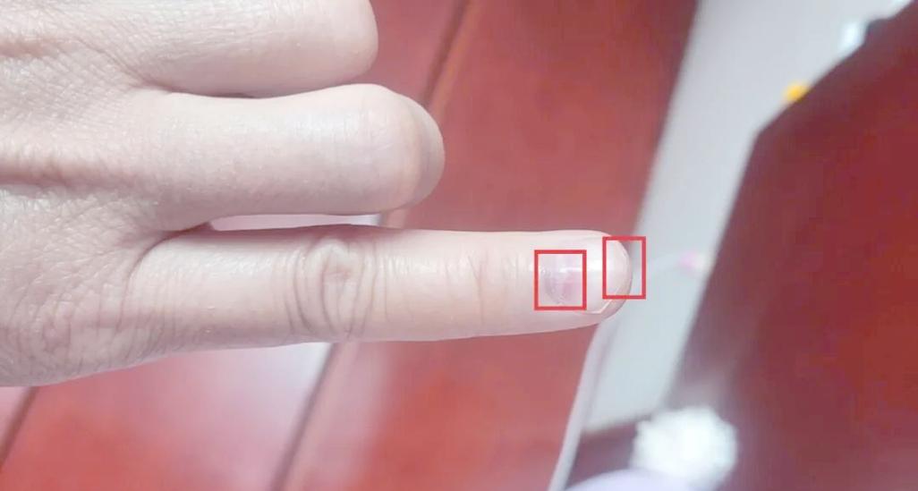 手指根里面有个小圆球