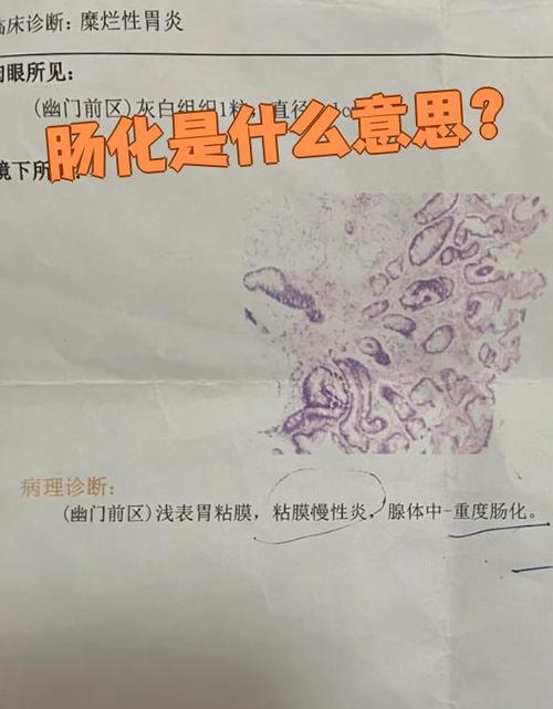 肠化是什么意思图标