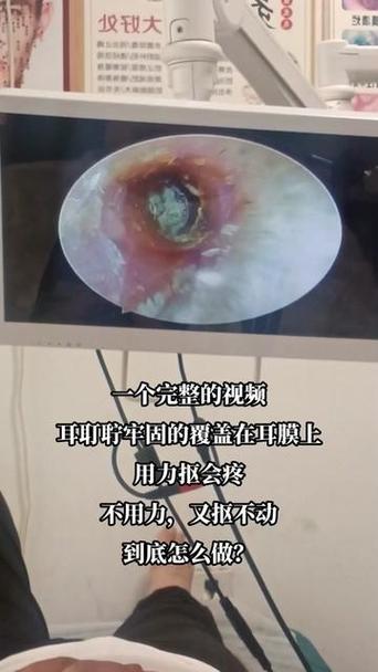 耳机孔被耳屎堵住了怎么办图标