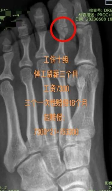 脚趾骨折算几级伤残图标