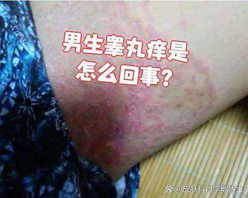 男人下面蛋蛋瘙痒怎么回事图标