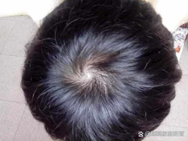 发旋怎么去掉截图