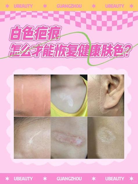 白色疤痕的治疗图标