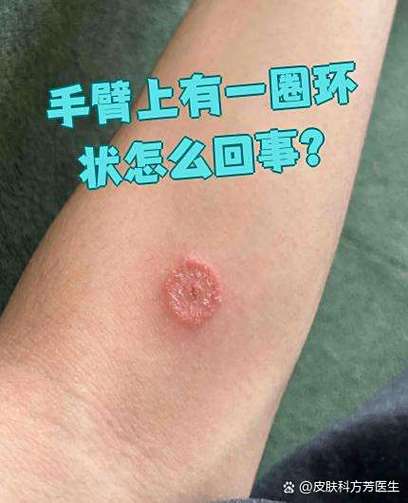 皮肤上出现白色圆圈是怎么回事图标