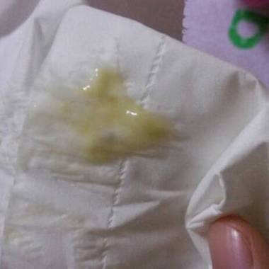 分泌物粘稠发黄截图