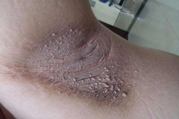 黑棘皮症状图片截图