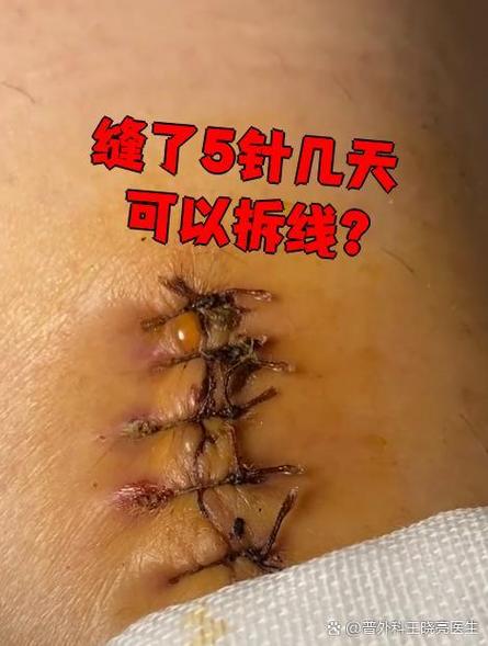 缝完针不用拆线多久能好图标