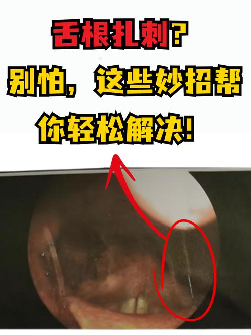 舌头根上扎刺取出妙招