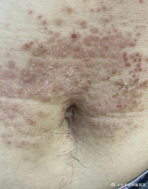 肚子上越挠越痒越挠越多截图