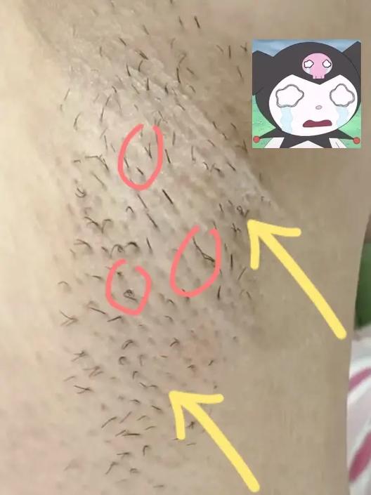 如何永久脱毛不再长图标