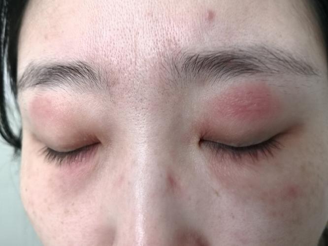 脸过敏眼睛肿是怎么回事图标