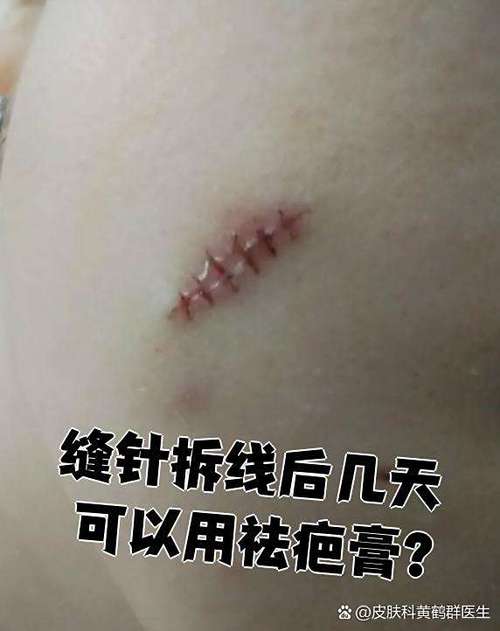 美容线缝合的疤痕还能去掉吗截图
