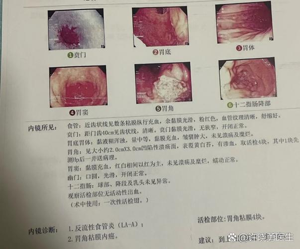 胃镜会不会感染传染病