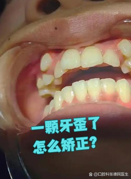 一颗门牙歪了可以单独矫正吗截图