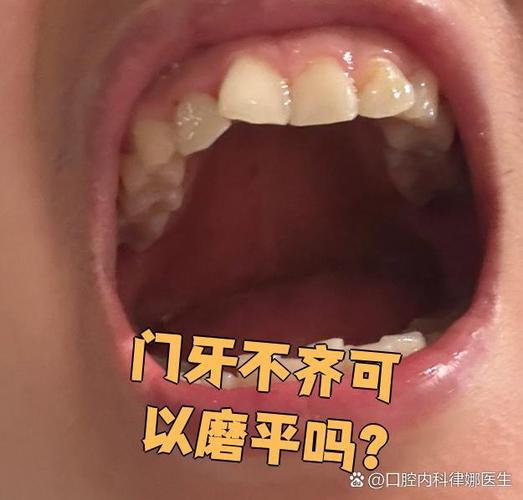 牙齿不整齐可以磨平吗截图