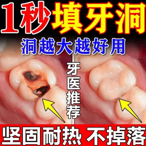 大牙烂个洞补上多少钱截图