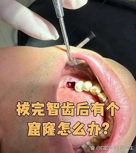 智齿拔了有个洞老是塞东西图标