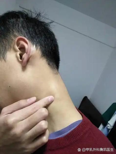 甲状腺炎性结节会消失吗图标