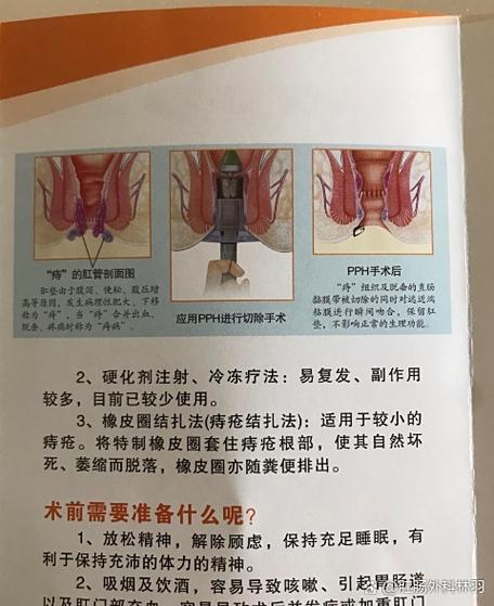 痔疮助推器怎么用截图