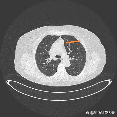 得了肺部瘤一般能活几年图标