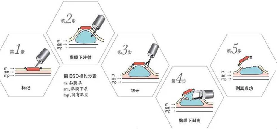 无痕微创水剥离图标