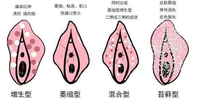 外阴白斑很可怕吗截图