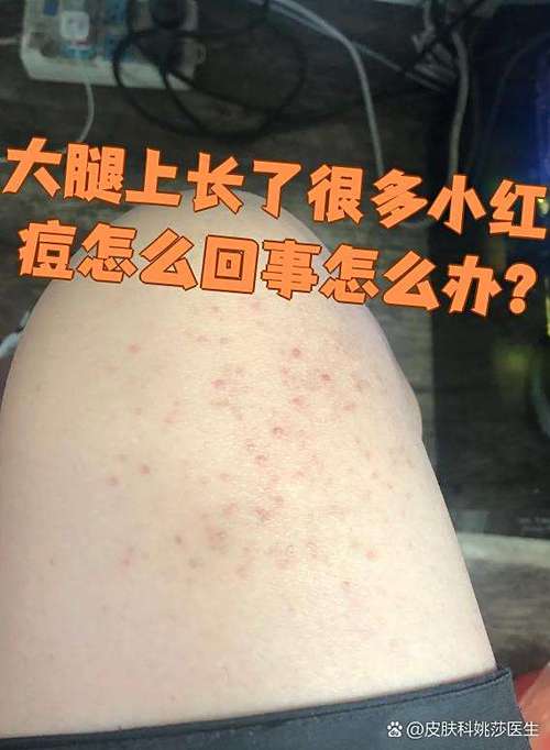 大腿一侧痒痒越抓越痒有小红疙瘩图标