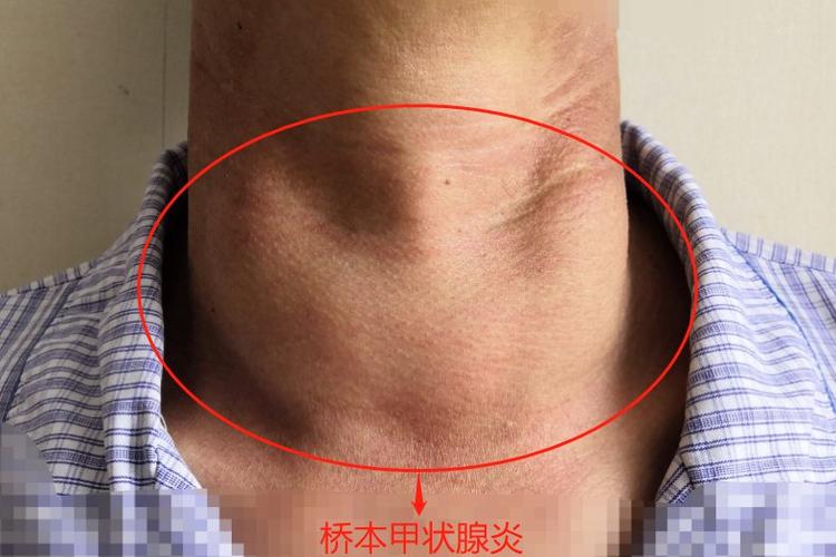桥本甲状腺炎的症状图标