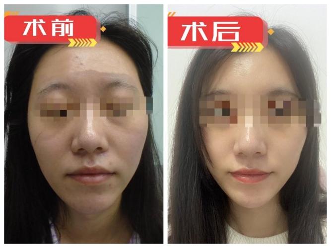 美图秀秀去法令纹教程图标