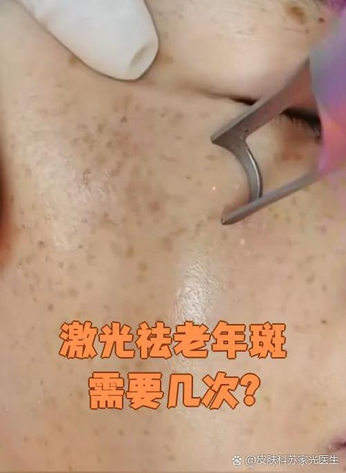 老年斑能用激光去掉吗截图