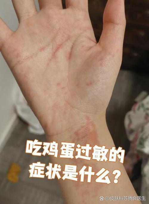皮肤痒能吃鸡蛋吗图标