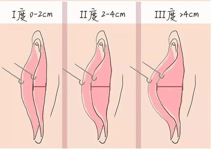 正常阴脣的图片和症状图标