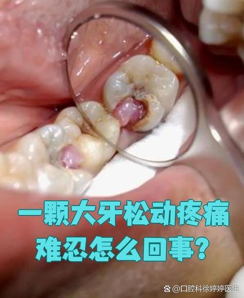 一颗大牙松动疼痛难忍