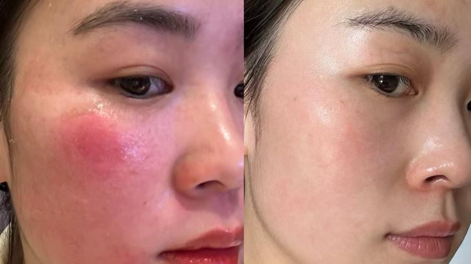 脸上皮肤红血丝怎么修复图标