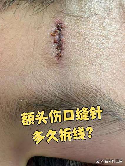 伤口缝合线会崩开吗图标