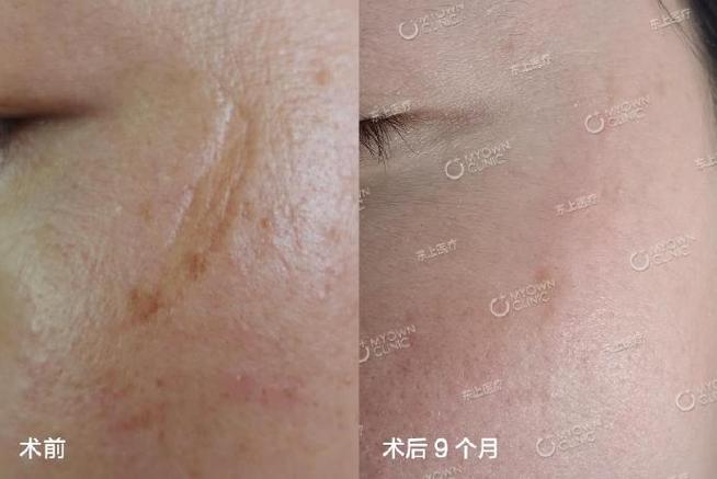 手术后疤痕怎么消除图标