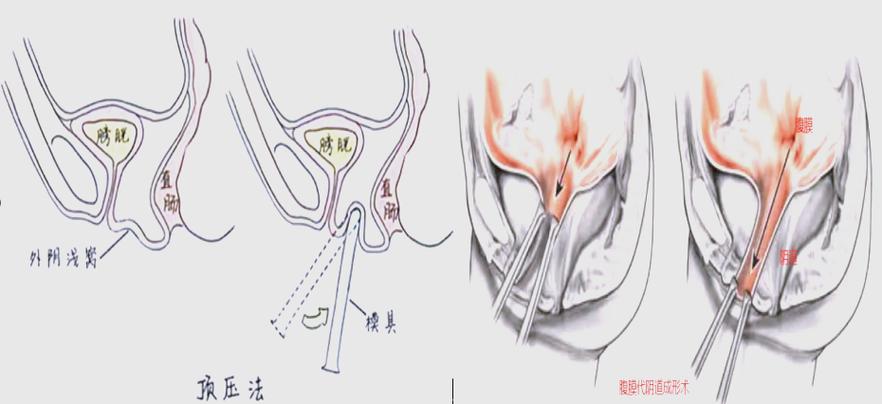 为什么石女不建议手术截图