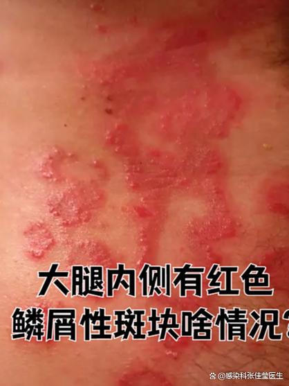 身上长红色圆斑图片图标